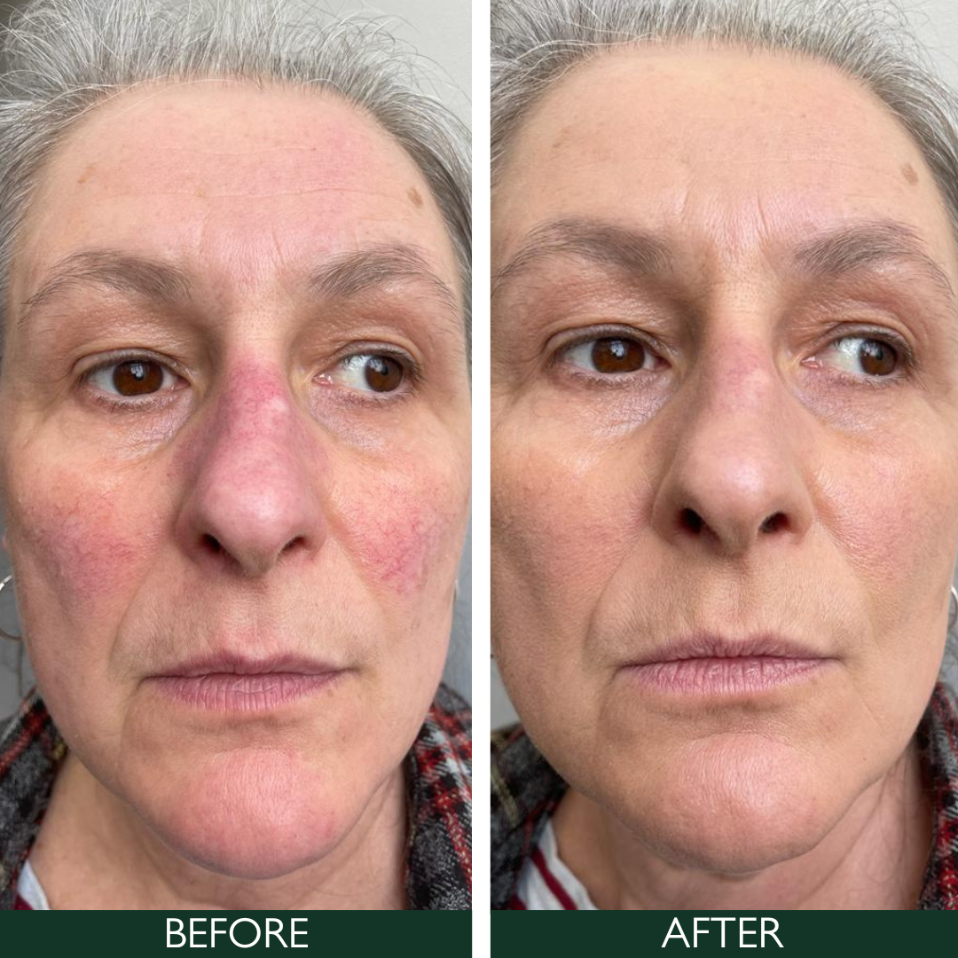 5 IN 1 ANTI-REDNESS DAY CREAM SPF50 – Sorted Skin